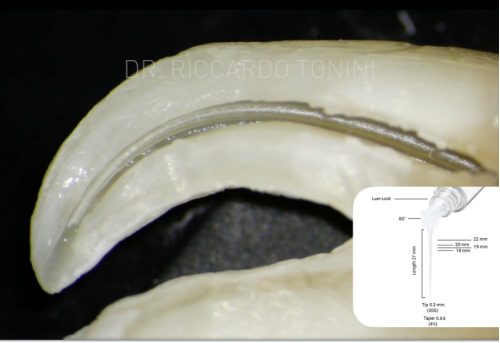 Irriflex Flexible Irrigation Needles - Universal Dental (Pvt) Ltd.