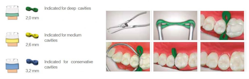 Elastic Wedges - Universal Dental (Pvt) Ltd.