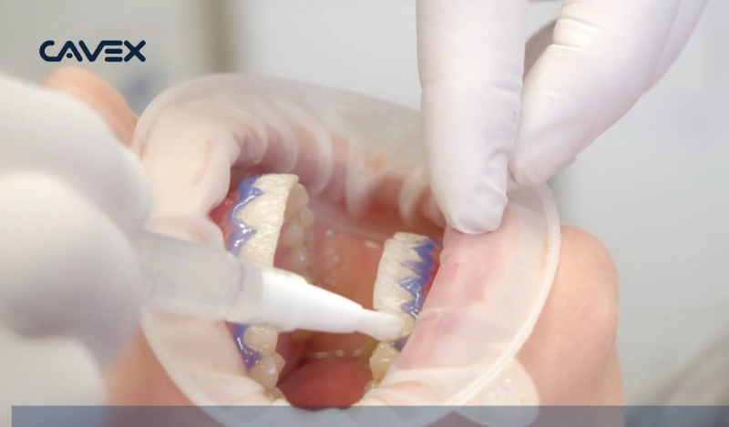 Whitening Kit | Cavex Bite and White (In Office Kit) |Universal Dental ...